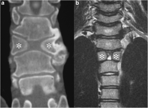 Malformed vertebrae: a clinical and imaging review | SpringerLink