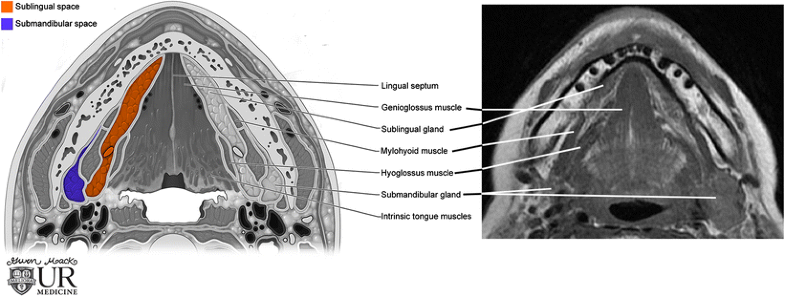 Imaging of the sublingual and submandibular spaces | SpringerLink