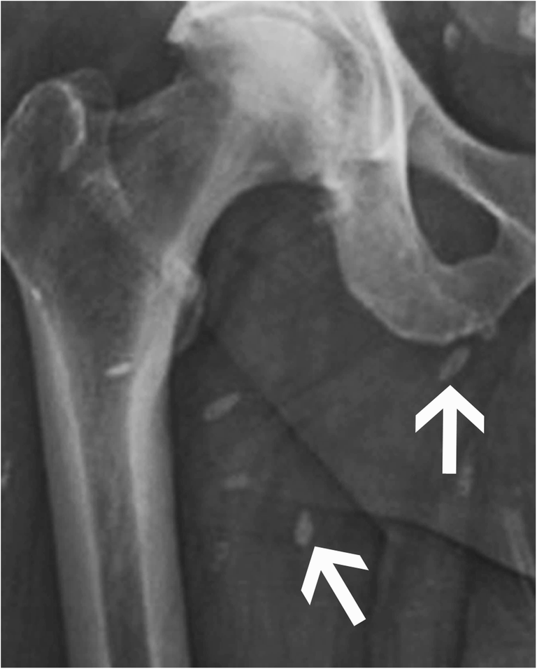 Radiological identification and analysis of soft tissue musculoskeletal ...