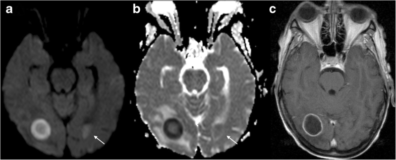Clinical applications of diffusion weighted imaging in neuroradiology ...