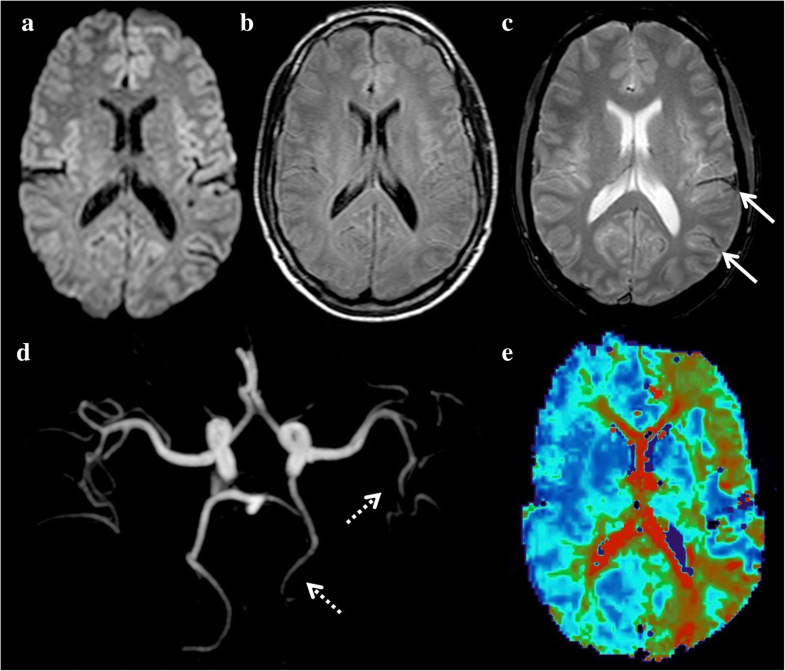 Magnetic resonance imaging of arterial stroke mimics: a pictorial ...