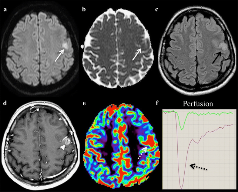 Magnetic resonance imaging of arterial stroke mimics: a pictorial review | Insights into Imaging ...