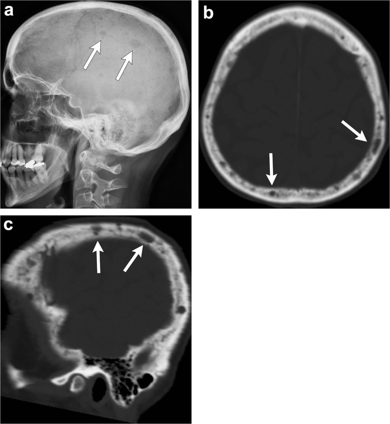 Radiological review of skull lesions | SpringerLink