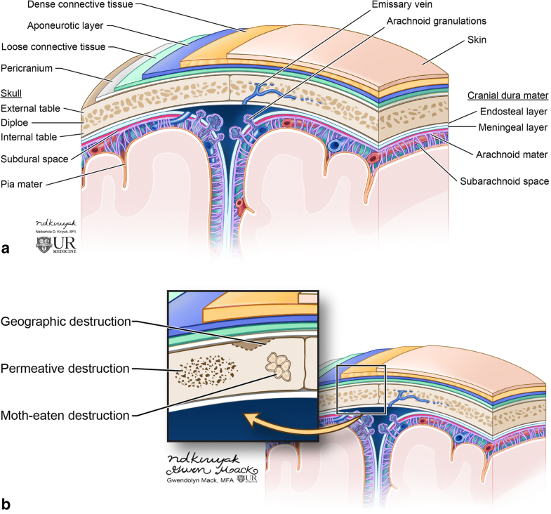 Radiological review of skull lesions | SpringerLink