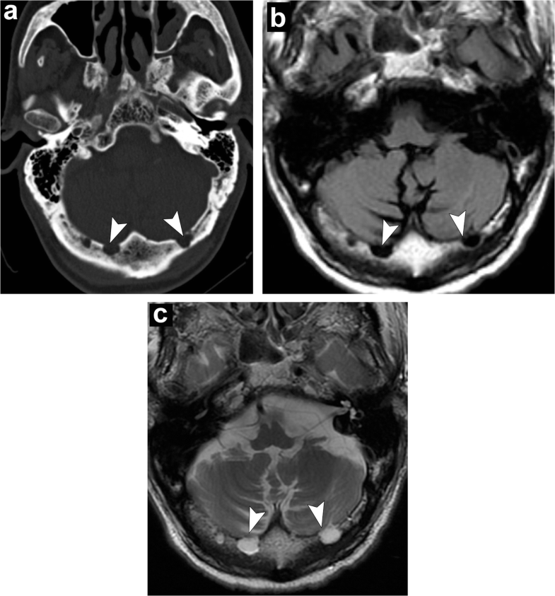 Radiological review of skull lesions | SpringerLink