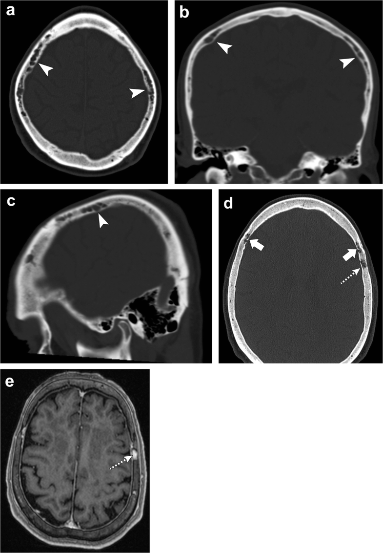 Radiological review of skull lesions | Insights into Imaging | Full Text