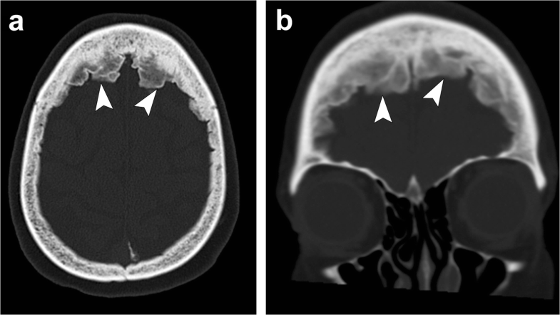 Radiological review of skull lesions | SpringerLink