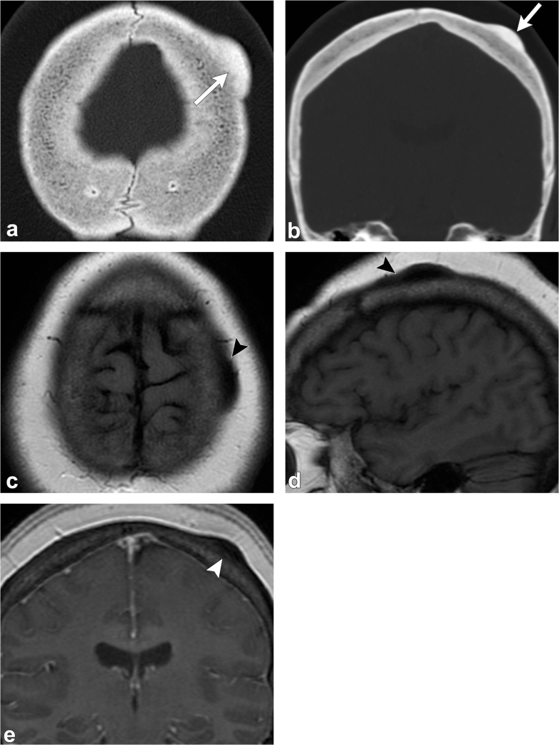 Radiological review of skull lesions | SpringerLink