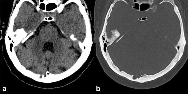 Spectrum of lytic lesions of the skull: a pictorial essay | SpringerLink
