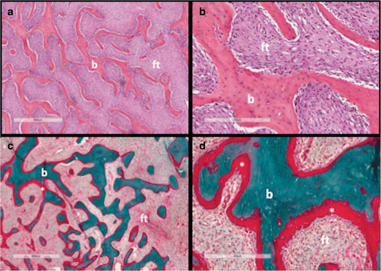 Fibrous dysplasia for radiologists: beyond ground glass bone matrix ...