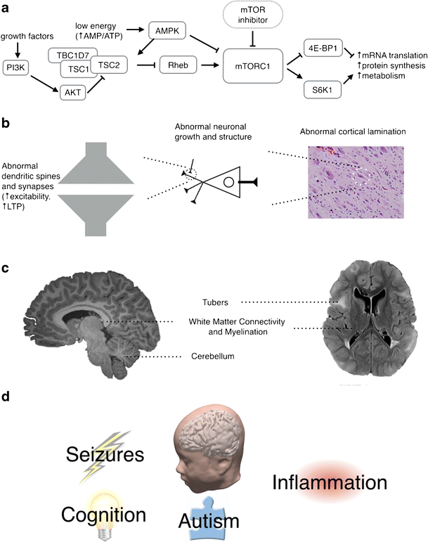 Tuberous Sclerosis: A New Frontier in Targeted Treatment of Autism ...