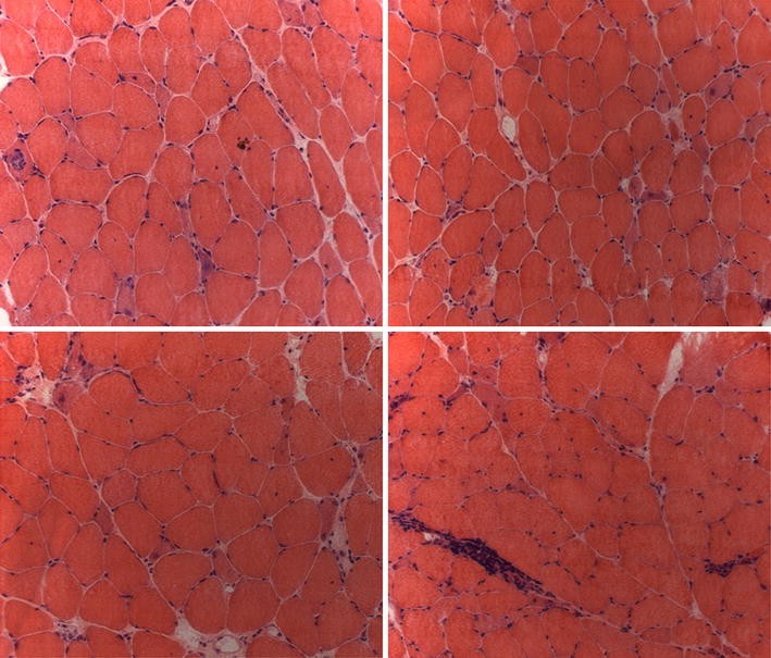 Myositis autoantibodies and clinical phenotypes | Autoimmunity ...