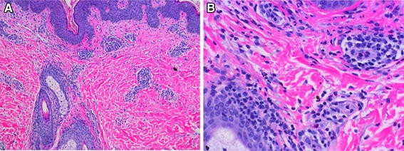 Typical evanescent and atypical persistent polymorphic cutaneous rash ...
