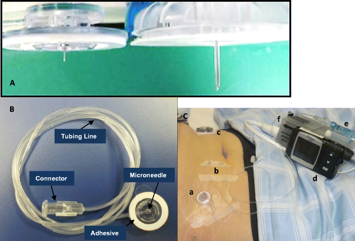 Intradermal insulin infusion achieves faster insulin action than ...