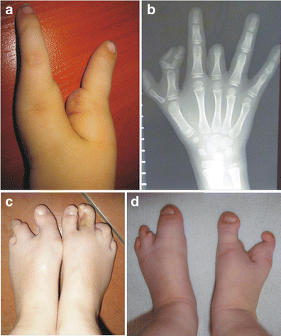 Split-hand/foot malformation - molecular cause and implications in ...