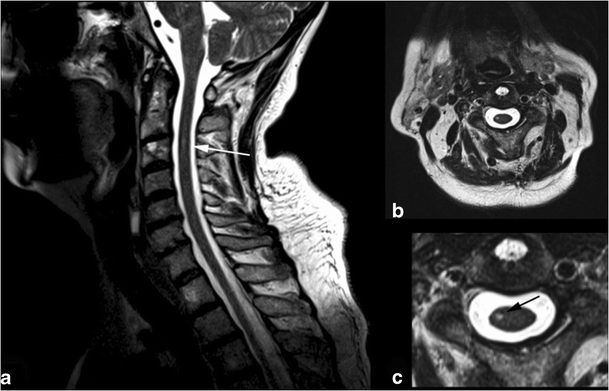 Spinal cord progressive multifocal leukoencephalopathy detected ...