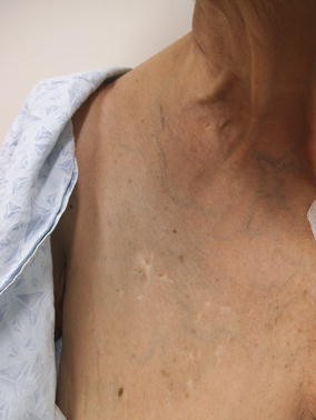 Hydroxychloroquine-Associated Hyperpigmentation Mimicking Elder Abuse ...