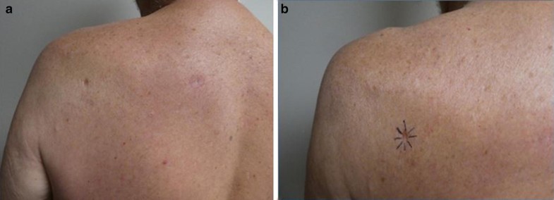 Atrophic Dermatofibroma: A Comprehensive Literature Review | SpringerLink
