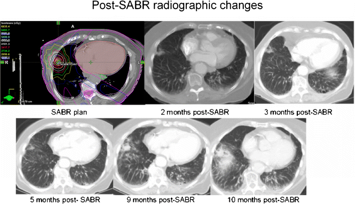 Imaging follow-up after stereotactic ablative radiotherapy (SABR) for ...