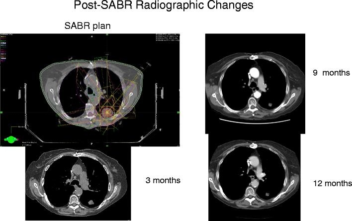 Imaging follow-up after stereotactic ablative radiotherapy (SABR) for lung tumors | SpringerLink