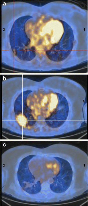 Imaging follow-up after stereotactic ablative radiotherapy (SABR) for ...