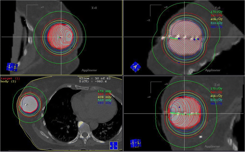 Clinical outcomes with the MammoSite radiation therapy system: results ...