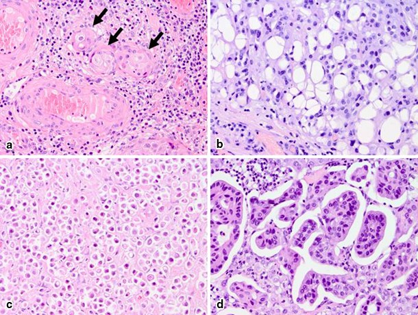 Blaaskankerpathologie: van cystoscoop naar microscoop | SpringerLink