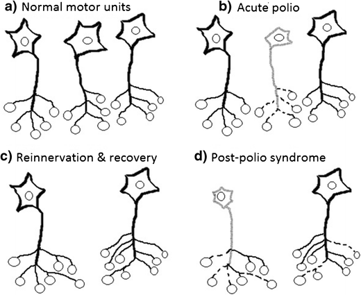 Post-Polio Syndrome, Implications for Geriatric Care | SpringerLink