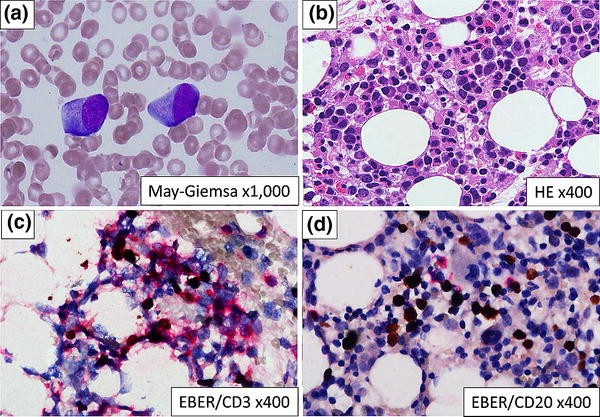 CD3 and EBER double positive cells in bone marrow are a diagnostic aid ...