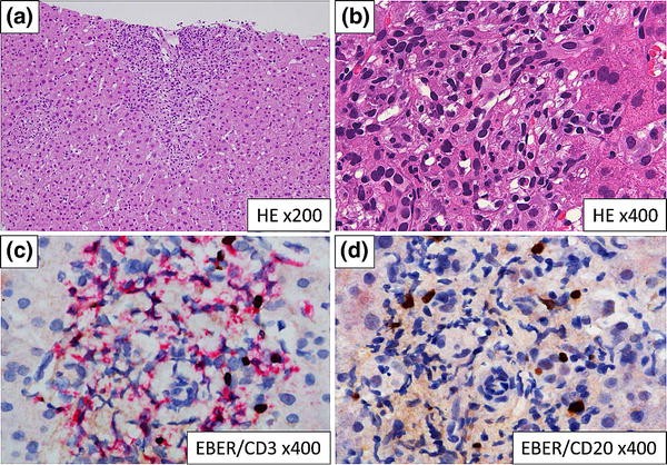 CD3 and EBER double positive cells in bone marrow are a diagnostic aid ...