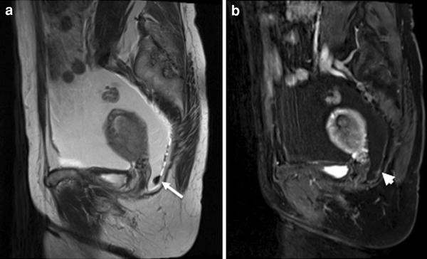 Endometrial carcinoma with peritoneal keratin granulomas mimicking ...