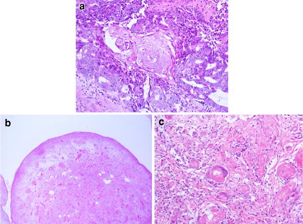 Endometrial carcinoma with peritoneal keratin granulomas mimicking ...