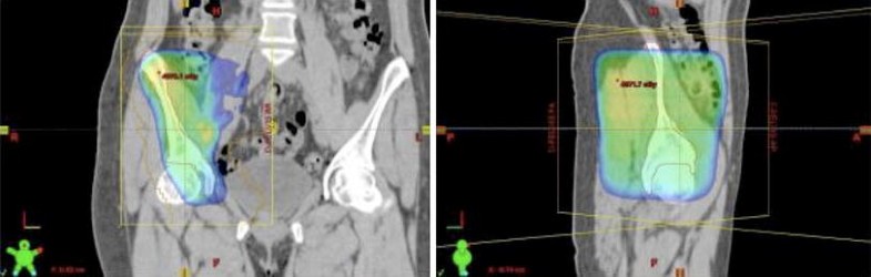 Radiation recall dermatitis: report of two cases | SpringerLink