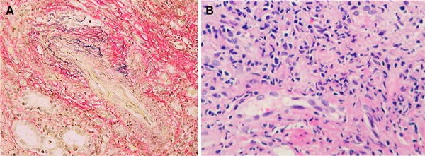 AP-VAS 2012 case report: MPO-ANCA-negative relapse of MPO-ANCA ...