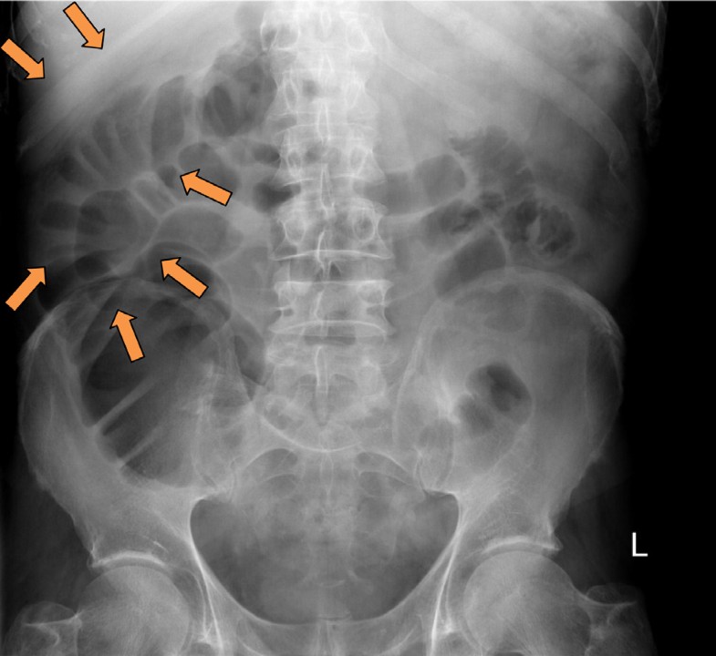 Dickdarmtumoren im Fokus | SpringerLink