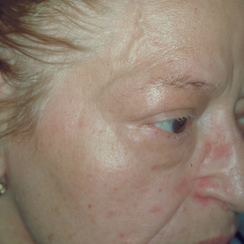 Ist es eine Vaskulitis? | SpringerLink