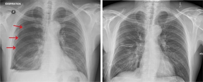 Rippenfraktur | SpringerLink