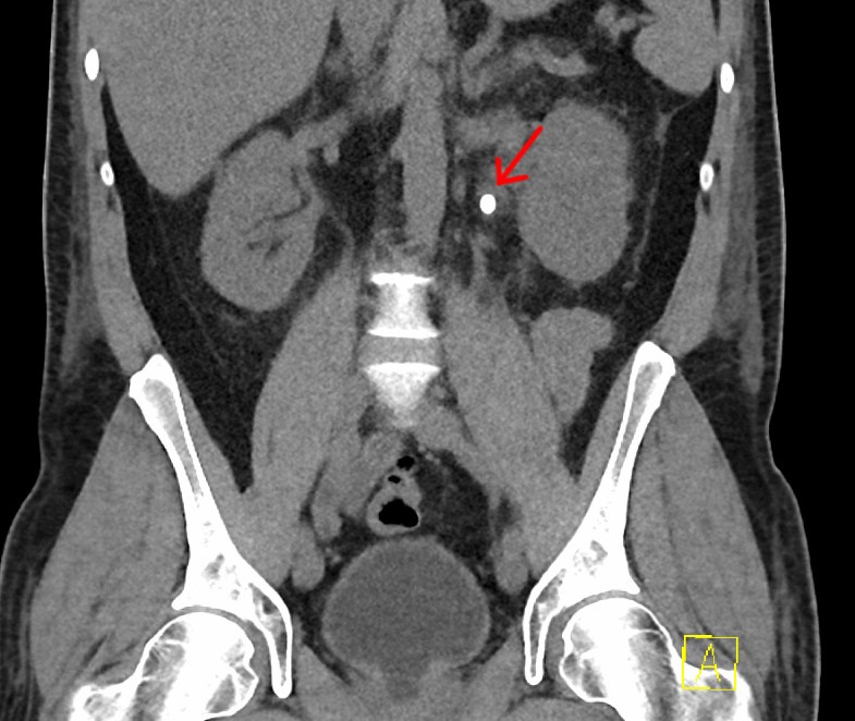 Die akute Nierenkolik | SpringerLink