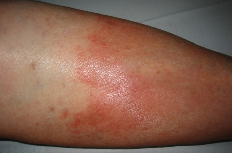 Erysipel: Wann wird es kritisch? | SpringerLink