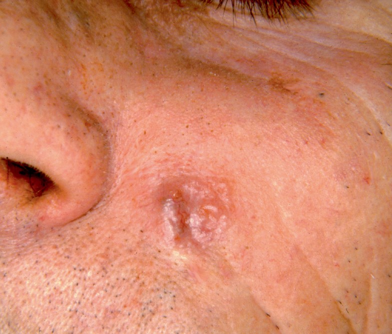 Das variable klinische Bild der Basalzellkarzinome | SpringerLink
