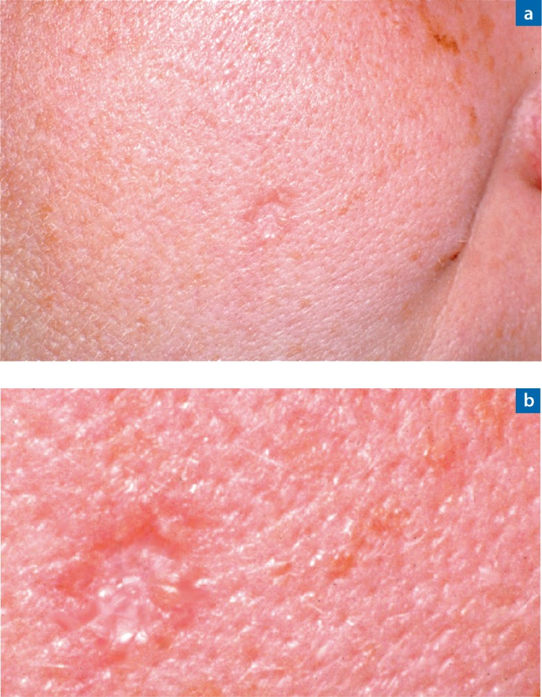 Das variable klinische Bild der Basalzellkarzinome | SpringerLink