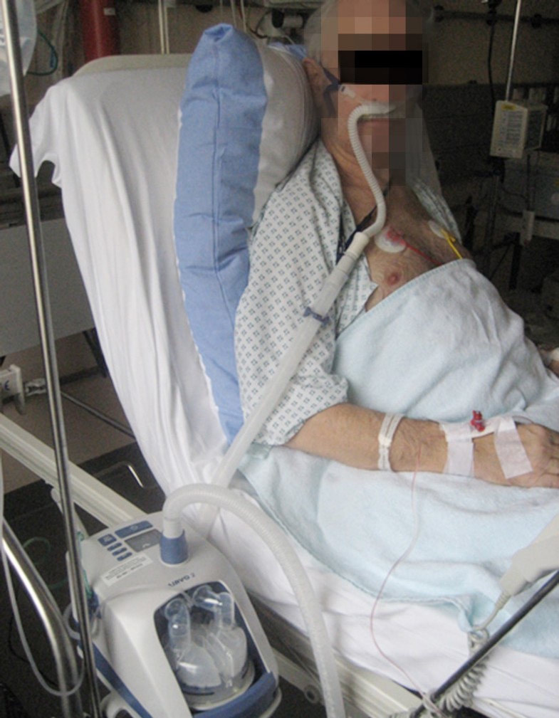 Nicht invasive Beatmung | SpringerLink