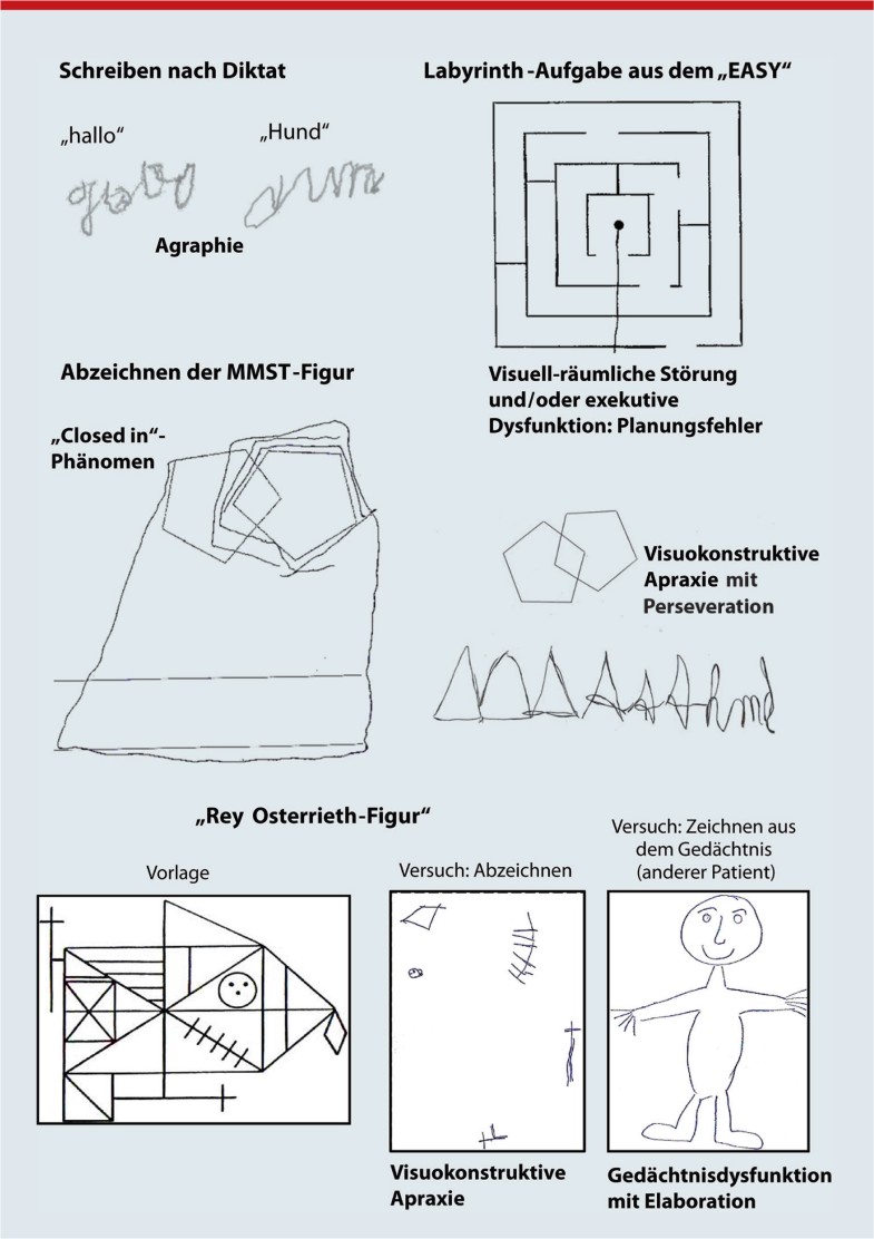 Demenz — welcher Test kann was? | SpringerLink