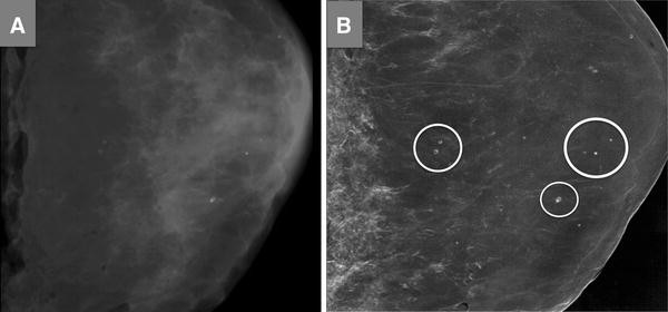 Grating-based X-ray dark-field imaging: a new paradigm in radiography ...