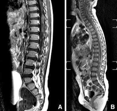 Medulloblastoma and Drop Metastasis: MRI Evaluation and Optimized ...