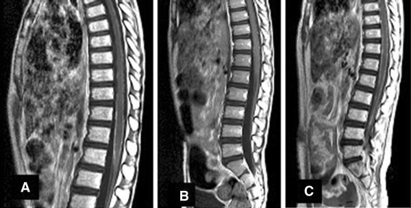 Medulloblastoma and Drop Metastasis: MRI Evaluation and Optimized ...
