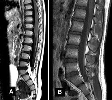 Medulloblastoma and Drop Metastasis: MRI Evaluation and Optimized ...