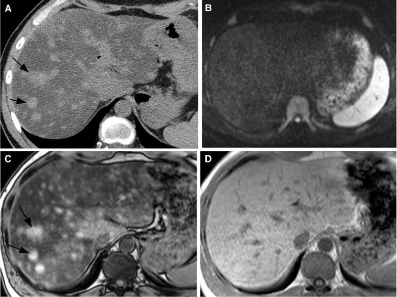 Patterns of Fatty Liver Disease | SpringerLink