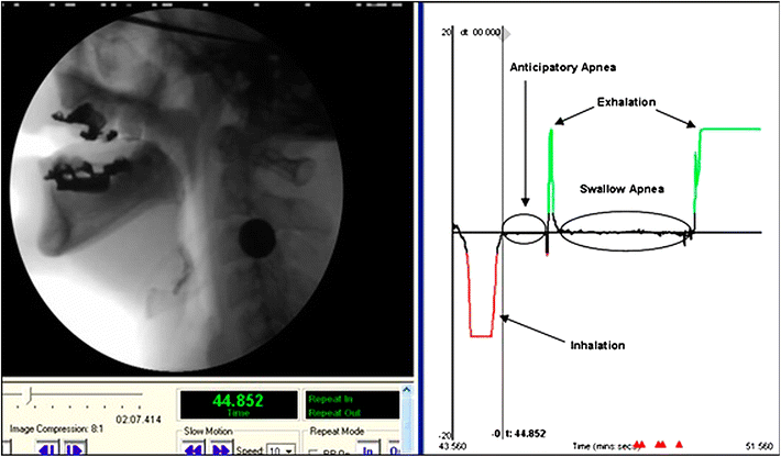 Continued Relevance of Videofluoroscopy in the Evaluation of ...