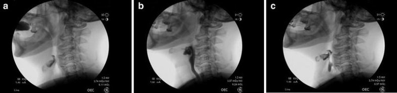 Continued Relevance of Videofluoroscopy in the Evaluation of ...